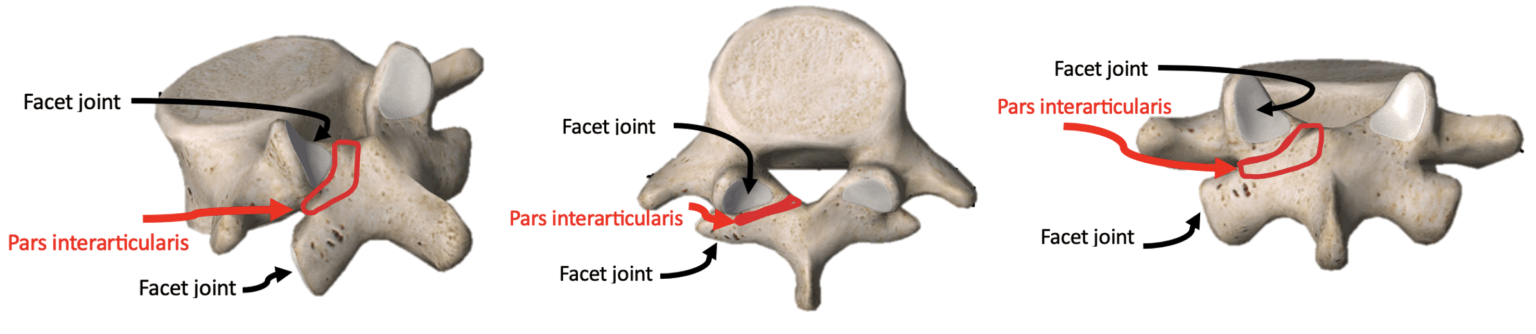 Pars Interarticularis Defect Injury • Peak Physio