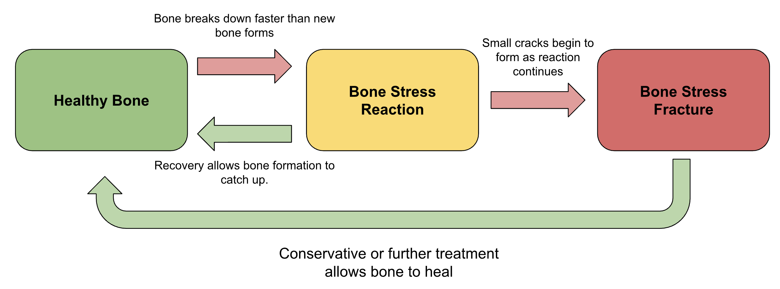 Bone Stress Injuries • Peak Physio